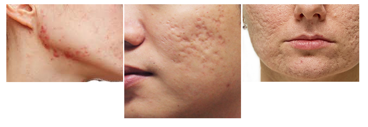 Acne Scarring – Keely Houghton